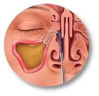 Balloon Sinuplasty also Known as Sinusoft Provides Long Lasting Relief from Sinus Pain